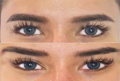 Fox Eye Thread Lift in Turkey